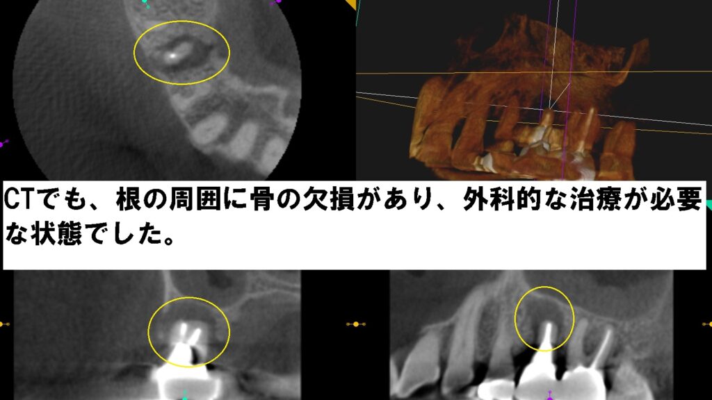 真っ二つに割れた歯を、意図的再植治療で復活! もろとみ歯科